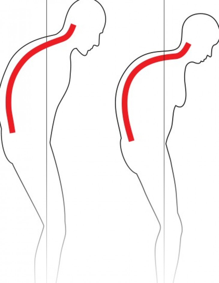 la cyphose - Actualités - Sante-dz