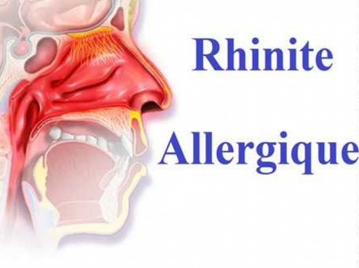 rhinite allergique (Le rhume des foins) - Actualités - Sante-dz
