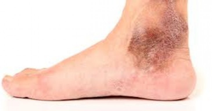 Ulcère variqueux - Actualités - Sante-dz